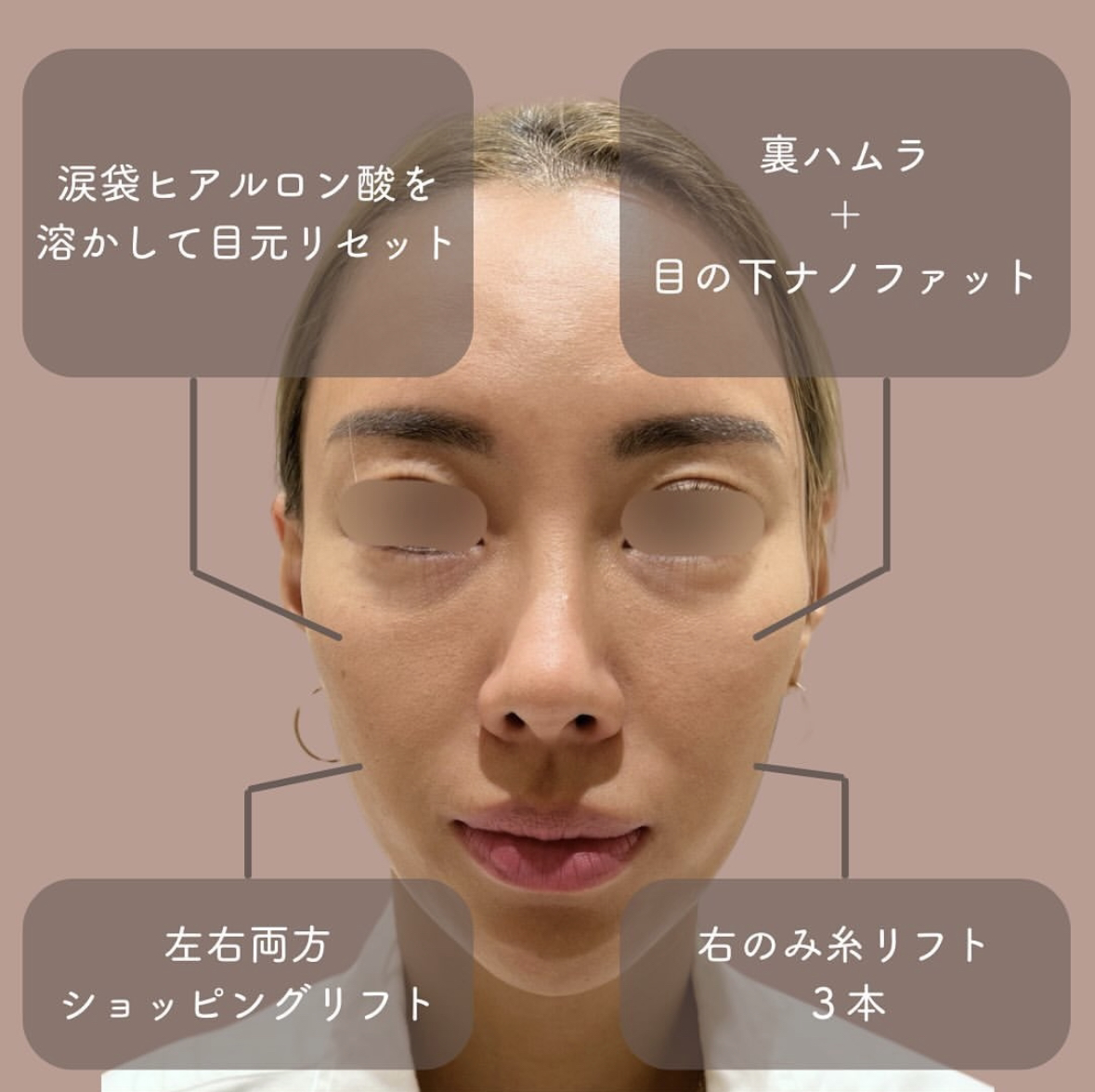 中顔面短縮美容施術 | 本山医師のブログ | 表参道・青山の美容整形「KAUNIS CLINIC カウニスクリニック」